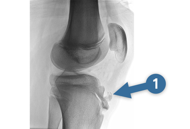 Patellar Tendonitis MRI & Imaging Guide for Diagnosis