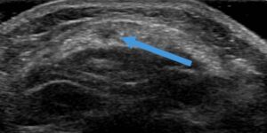 Patellar Tendonitis MRI & Imaging Guide for Diagnosis
