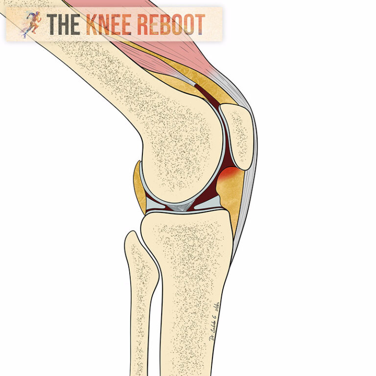 Patellar Tendonitis vs Other Knee Pain: The Big Mistake